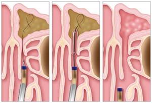 Balloon Sinuplasty Treatment, Block Sinus - Essex & London ENT