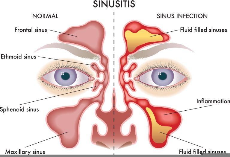 Sinusitis, Sinus Treatment - Essex & London ENT